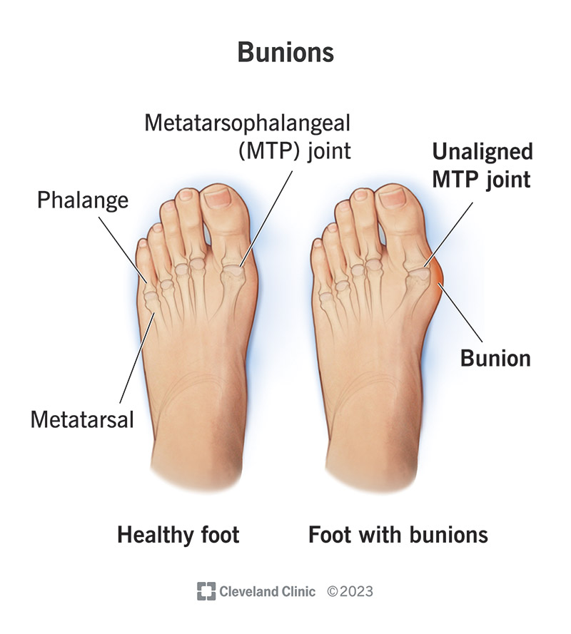 Bunions - In Mobility